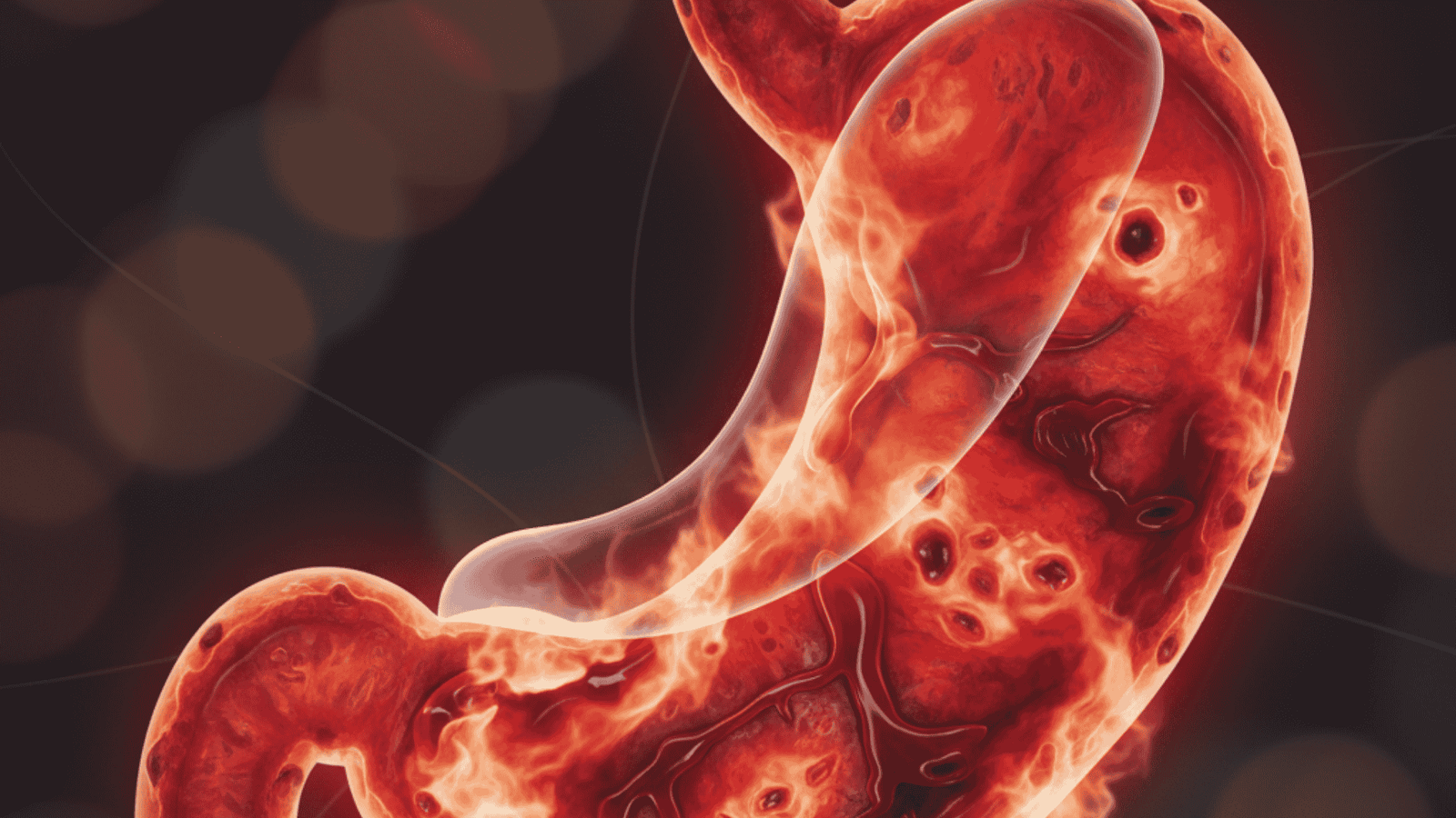 Tudo sobre a Gastrite - Nutrologia e Dermatologia - Dra. Leires Ferreira